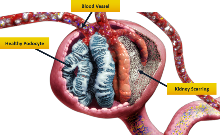 An Inside Look: Precision Medicine, Podocytes, and Goldfinch Bio - NephCure